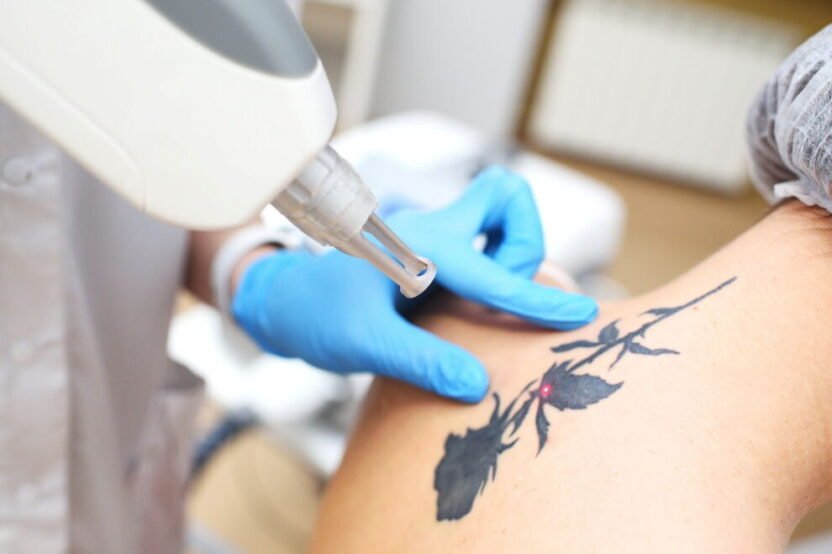 Laser tattoo removal: Does it fade all colors? - Cole Magazines